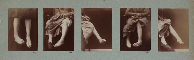 Hysteria : Les planches du docteur Charcot à la Salpêtrière ...